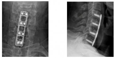 Anyone have experience w/ multi-level ACDF (Disk) Fusion? | RallyPoint